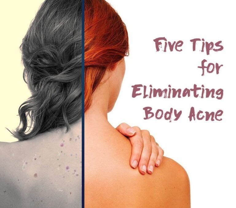 Five Tips for Eliminating Body Acne - The Health Science Journal