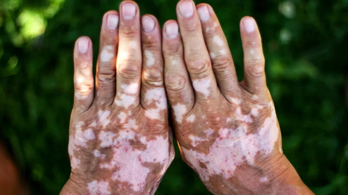 The Clinical Pathway for Managing Chronic Skin Discoloration - The ...