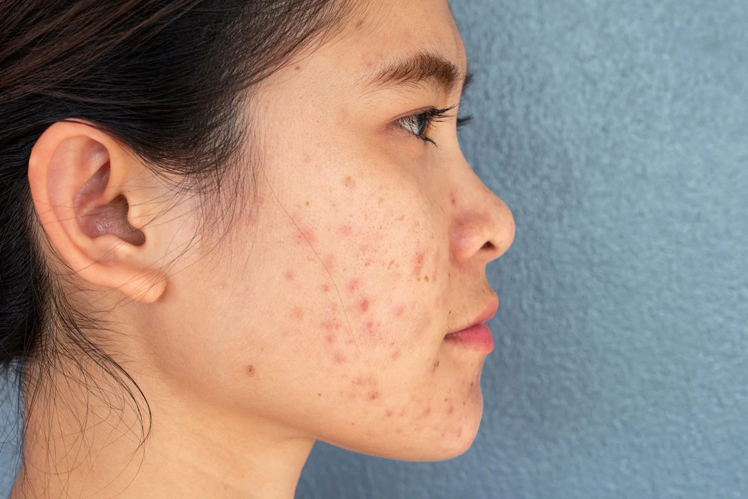 What Risks Exist When Acne Scars Are Left Untreated? - The Health ...